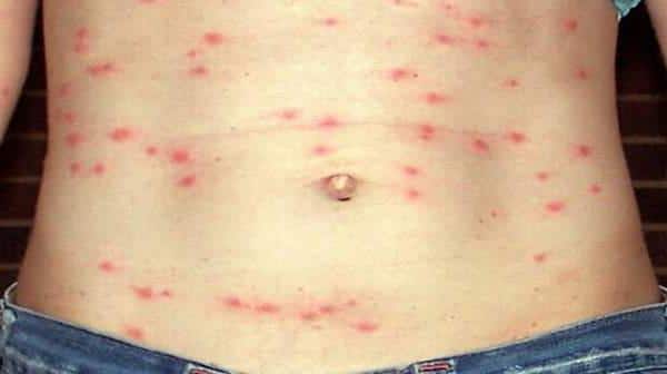 Pulgas: Reproducción, enfermedades, síntomas y más.